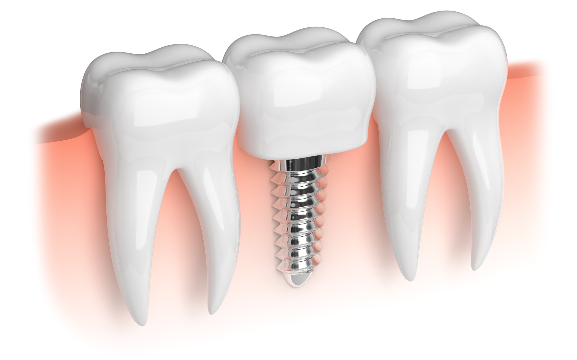 Mieux comprendre le processus d’installation d’implants dentaires