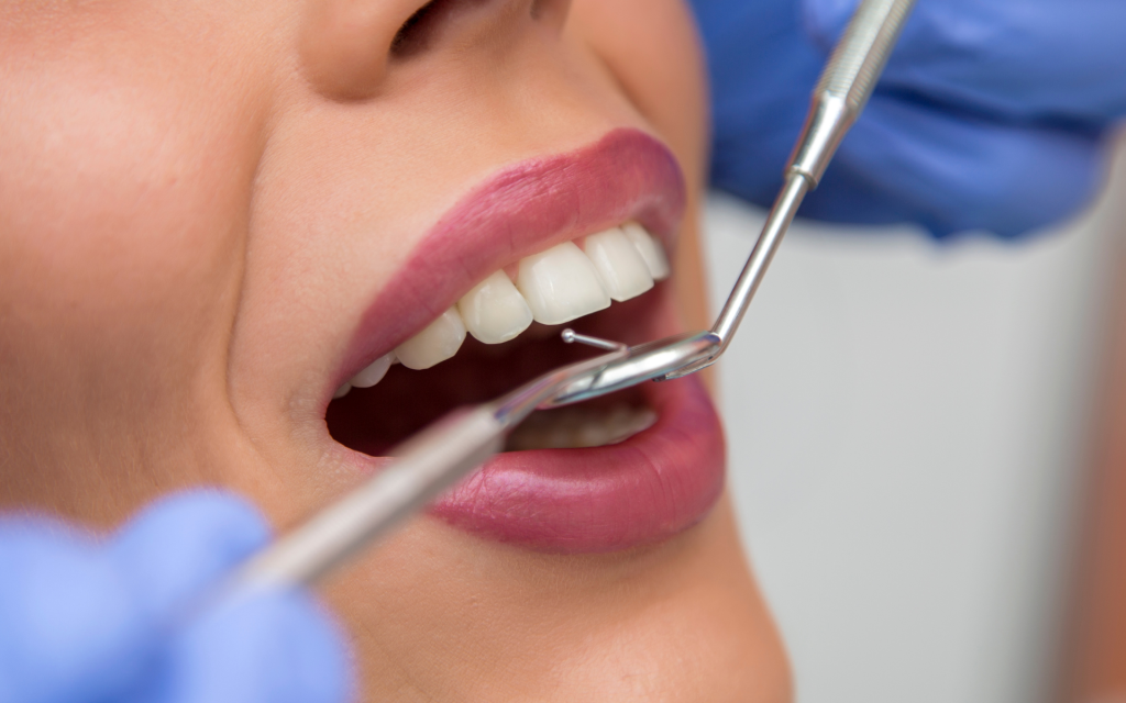 What Is Dental Erosion and How Can You Prevent it?
