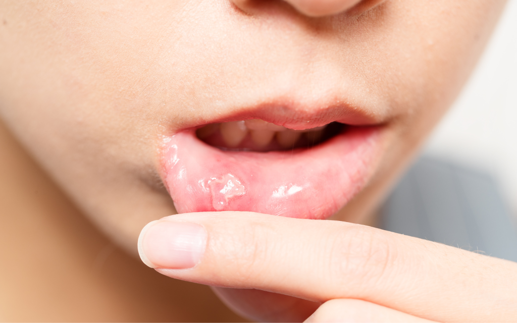 I’ve Got Mouth Ulcers, But What Are They?